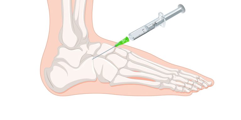 Ankle Cortisone Injections in Queens, NY | Targeted Pain Relief